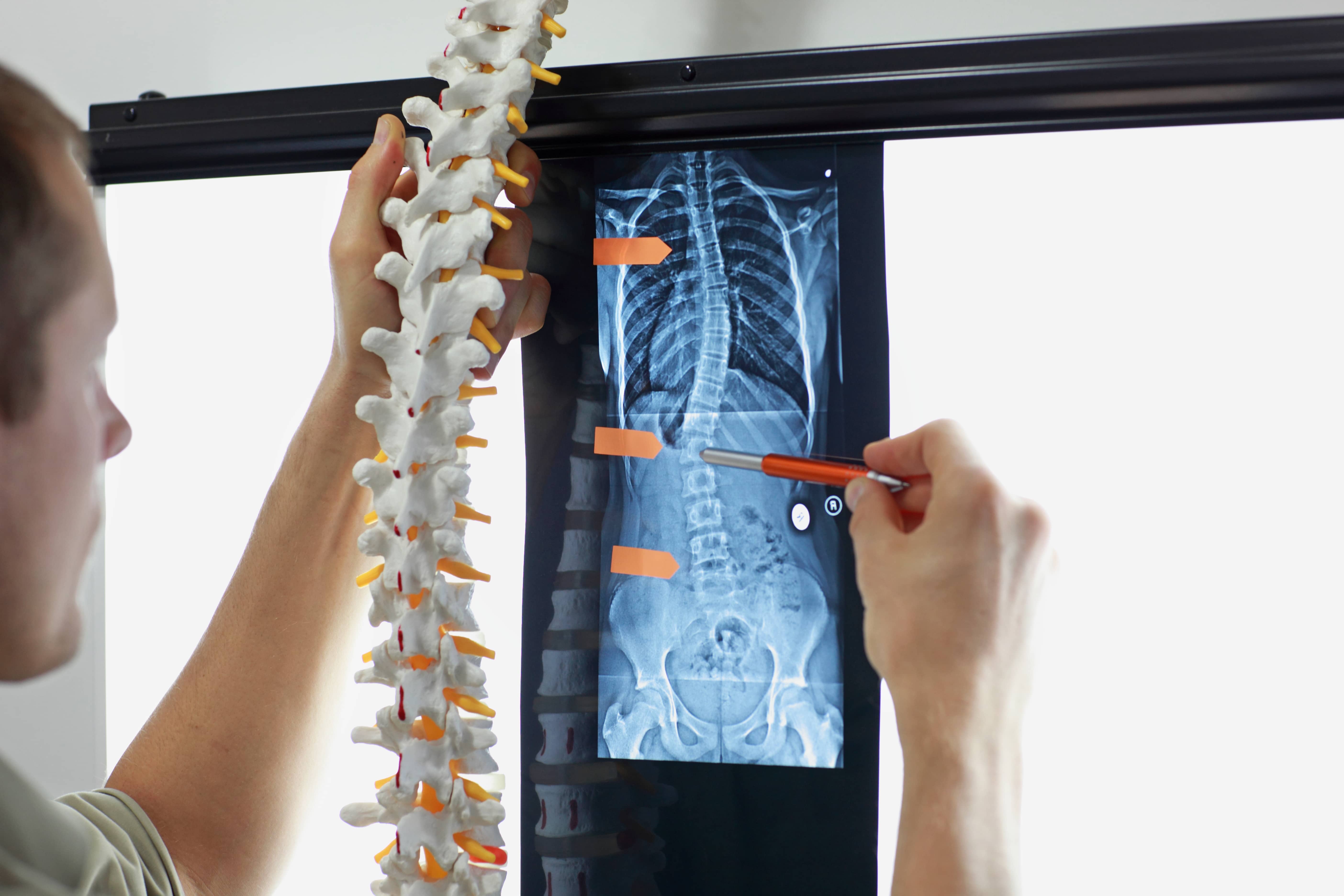 What Is Scoliosis and How Can You Treat It?