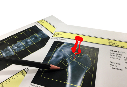 What to Expect in a DEXA Scan?