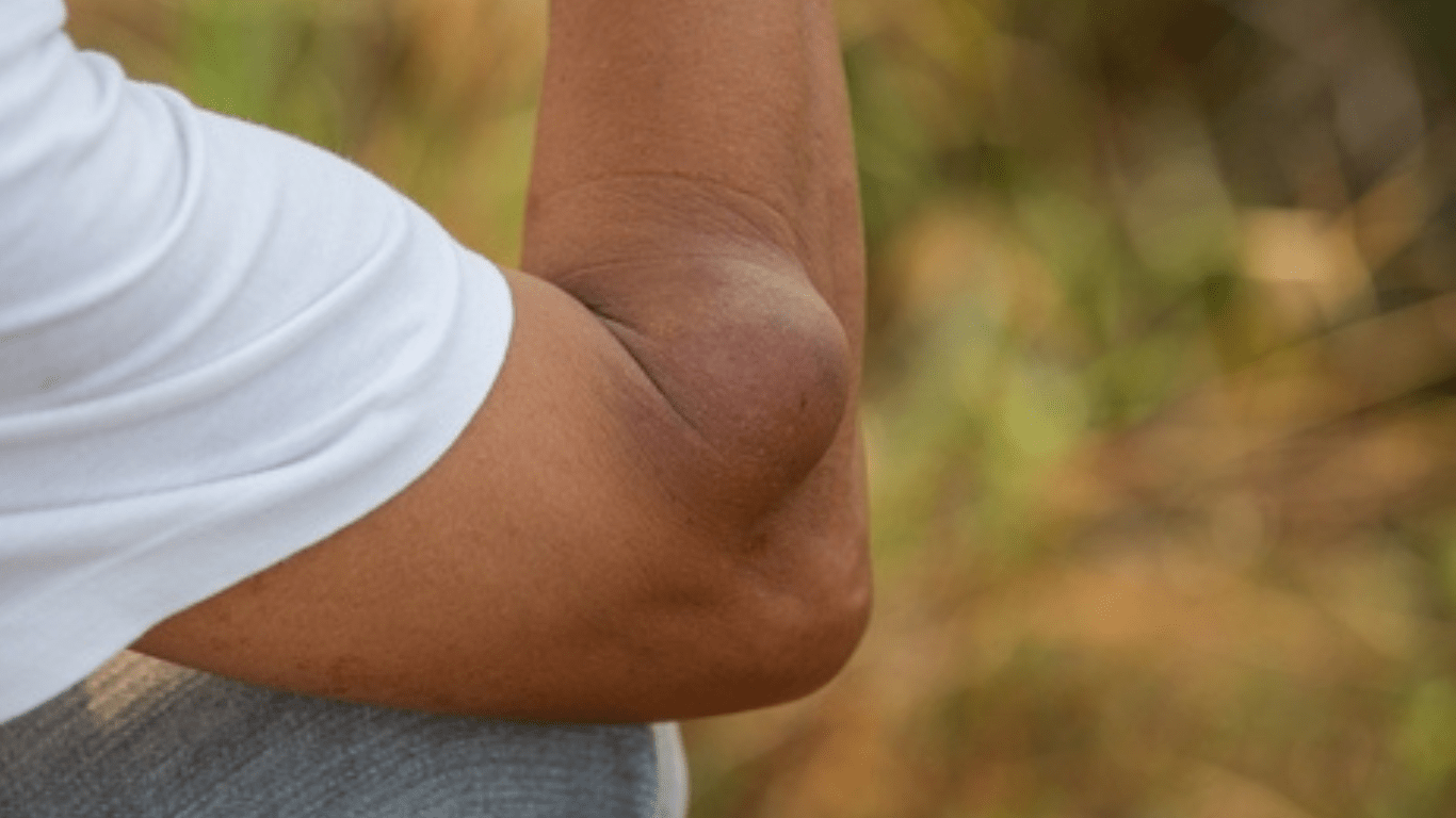 What is Sarcoma Cancer? Understand the Causes and Symptoms